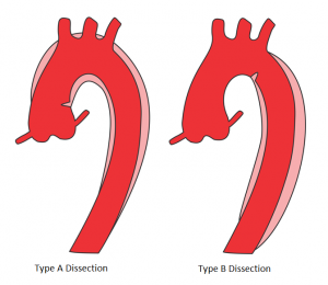 About Aortic Dissection – Living With Aortic Dissection